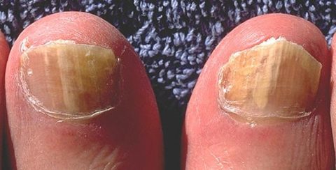 Uñas con hongos: Tratamiento efectivo con un profesional en podología.